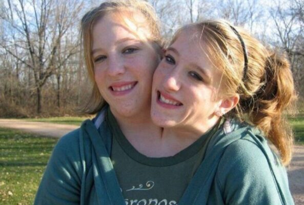 One husband for two sisters! Siamese twins revealed their wedding ...