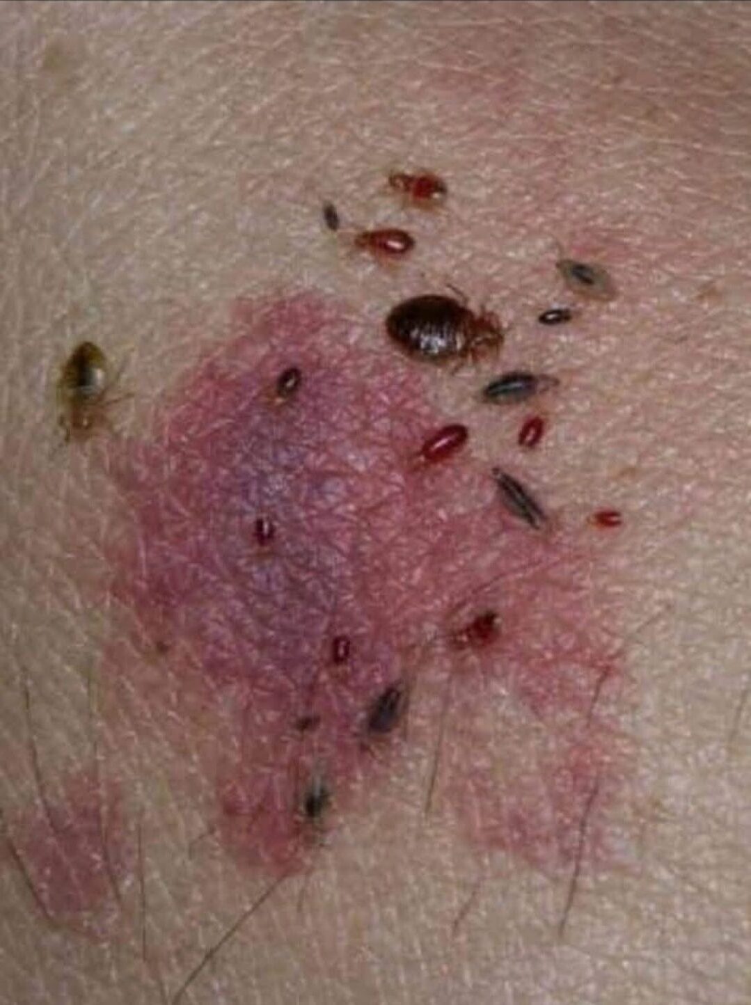 Understanding Scabies - STORIES