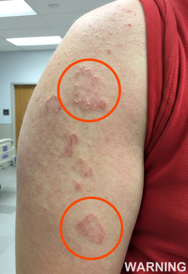 If you see red marks appearing on your arm, that's a sign of ca ...